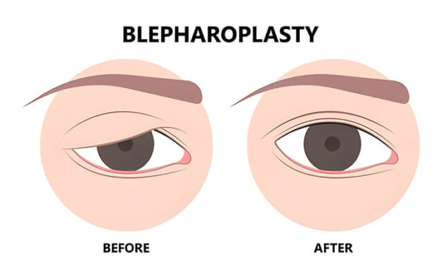 Blepharoplasty (Upper & Lower Eyelid Surgery) | Dr Lokesh Handa